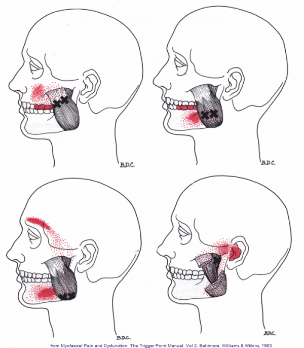 TMJ Pain & The Masseter Muscle