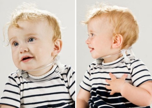 Tot Collar - Torticollis Treatment