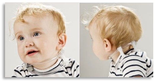 Tot Collar - Torticollis Treatment