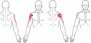Shoulder Strain - Casues, Symptoms & Treament Details