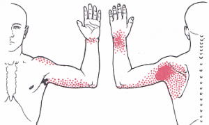 Shoulder Strain - Casues, Symptoms & Treament Details