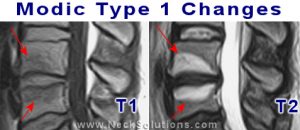 Chiropractic Management Of Modic Changes - A Complicating