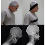 Dropped Head Syndrome - Diagnosis, Management & Treatment