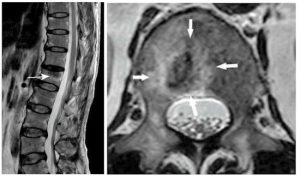 Schmorl's Nodes - Causes, Symptoms, & Treatment