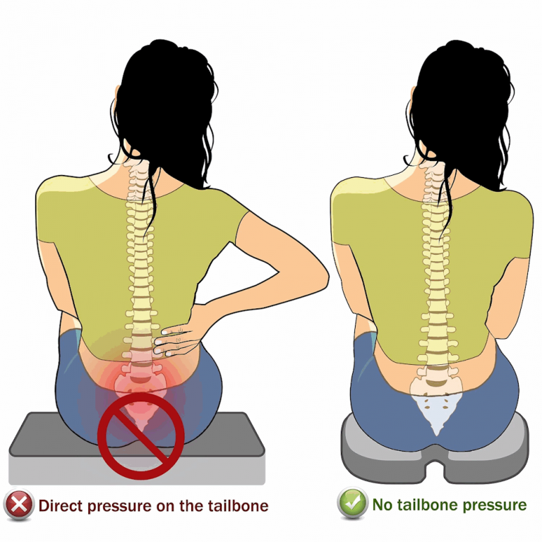 Tailbone Pain Causes Treatment For Coccyx Tailbone Pain Causes Treatment For Coccyx