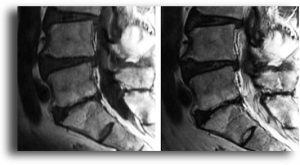Lumbar Modic Changes & Chronic Back Pain Details