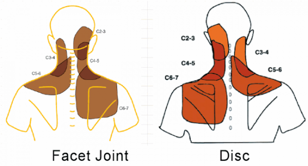 Facet Joint Syndrome - Spinal Facet Syndrome Joint Pain