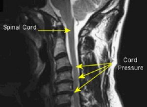 Myelopathy - Spinal Cord Compression Signs & Symptoms