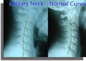 Military Neck - What Is It? Should It Be Corrected? & How To Fix It