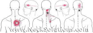 Neck Strain - Specific Help For Painful Neck Muscles