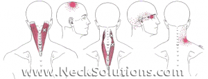 Neck Strain - Specific Help For Painful Neck Muscles