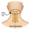 Rheumatoid Arthritis Neck - Rheumatoid Arthritis Of The Cervical Spine