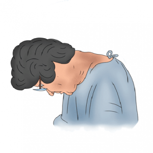 Dropped Head Syndrome - Diagnosis, Management & Treatment