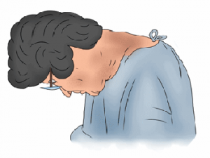 Dropped Head Syndrome - Diagnosis, Management & Treatment