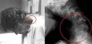 Dropped Head Syndrome - Diagnosis, Management & Treatment