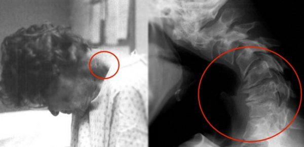 Dropped Head Syndrome - Diagnosis, Management & Treatment