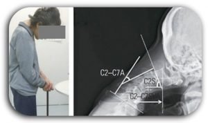 Neck Muscle Degeneration & Drop Head Syndrome