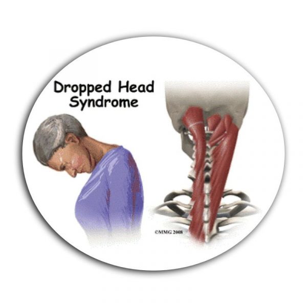 Neck Muscle Degeneration & Drop Head Syndrome