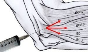 Elbow Pain - Causes & Treatments For Tennis Elbow