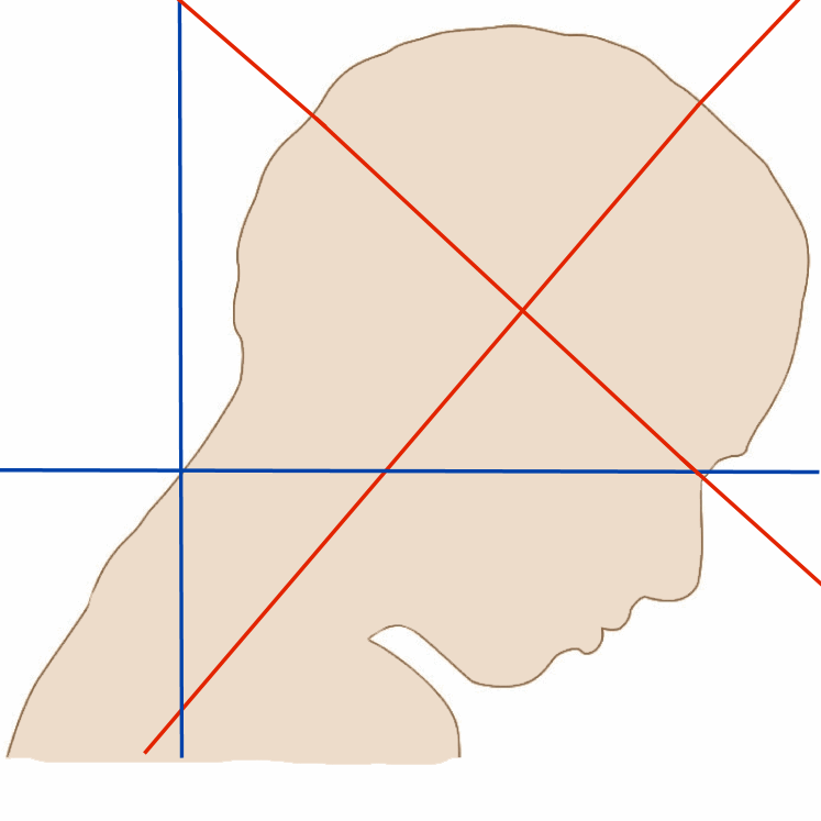 ALS Head Support - Head Control in Amyotrophic Lateral Sclerosis