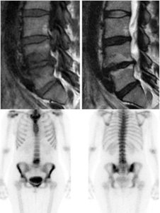 Modic Changes - Spinal Disease Or Normal Finding?