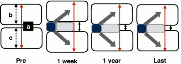 Myelopathy - Spinal Cord Compression Signs & Symptoms