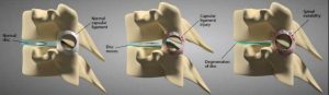 Facet Joint Syndrome - Spinal Facet Syndrome Joint Pain