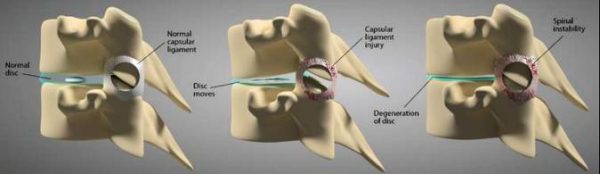 Facet Joint Syndrome - Spinal Facet Syndrome Joint Pain