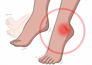 Foot Drop - Drop Foot Syndrome