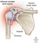 Understanding Frozen Shoulder