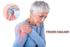 Understanding Frozen Shoulder