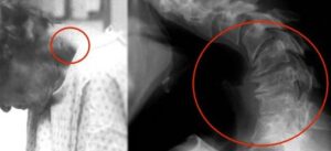 Dropped Head Syndrome - Diagnosis, Management & Treatment